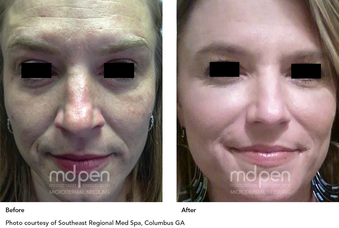 Microneedling Treatment for Scars & Wrinkles in West Melbourne & Palm ...