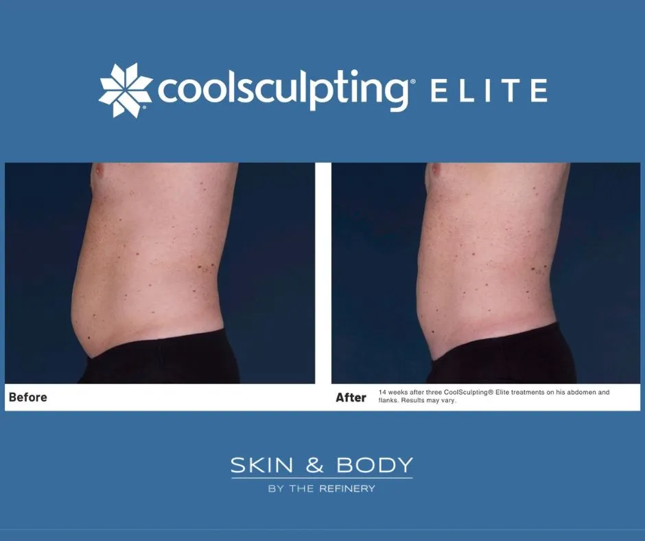 How Does CoolSculpting Work? The Science Behind Permanent Fat Cell Removal